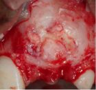 Complex-compound Odontoma: A Case Report - Oral Health Group