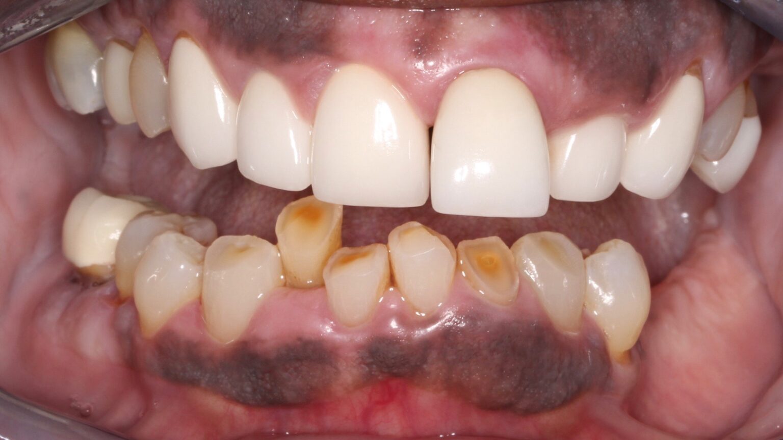 Predictable Aesthetic Success with a Digital Workflow