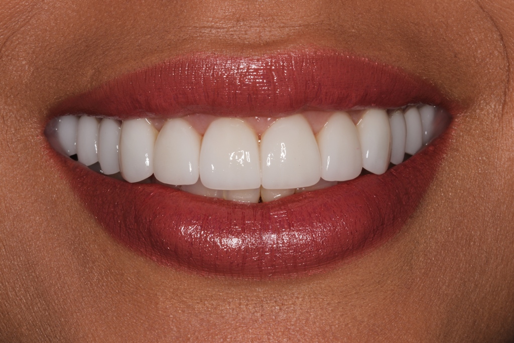 Smile Enhancement with Multiple Conservative Modalities