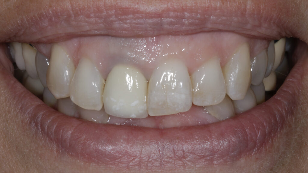 Solving the Single Tooth Dilemma - Oral Health Group