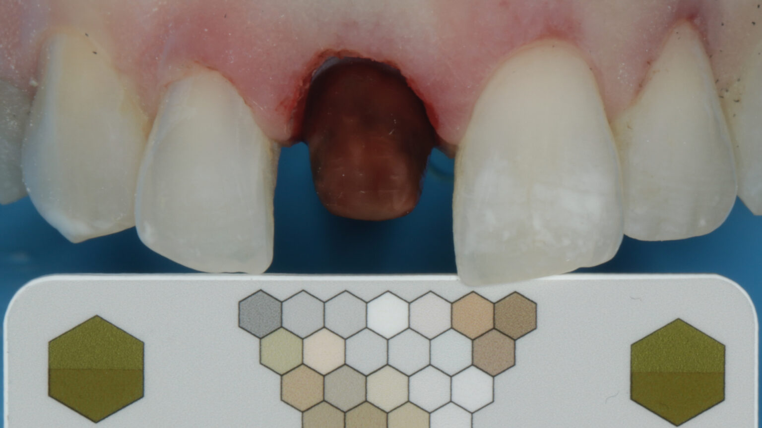 Solving the Single Tooth Dilemma - Oral Health Group