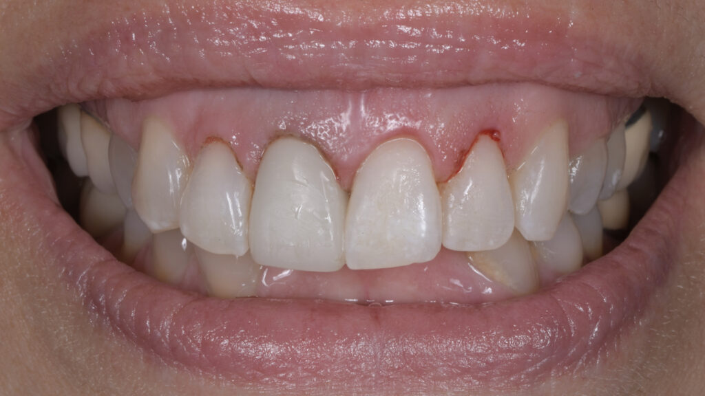 Solving the Single Tooth Dilemma - Oral Health Group