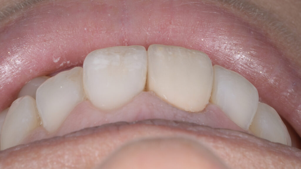 Solving the Single Tooth Dilemma - Oral Health Group