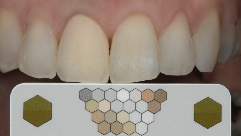 Solving the Single Tooth Dilemma - Oral Health Group