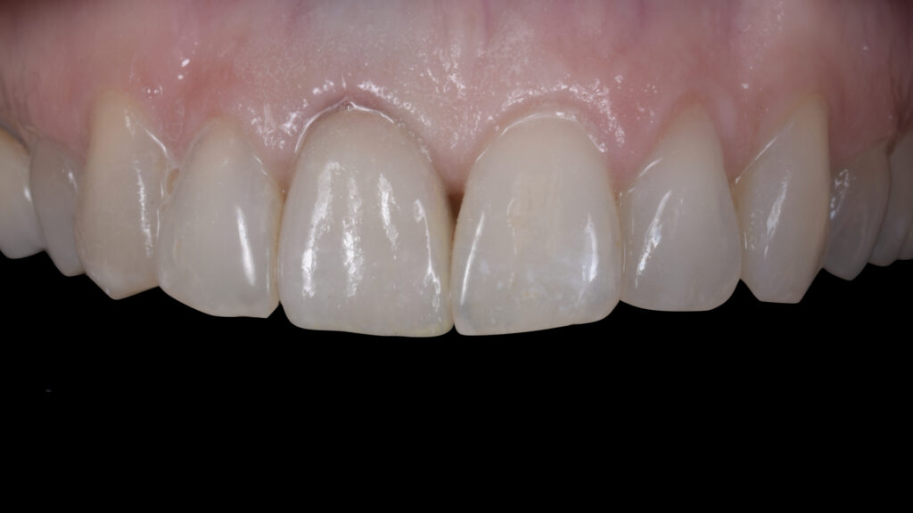 Solving the Single Tooth Dilemma - Oral Health Group