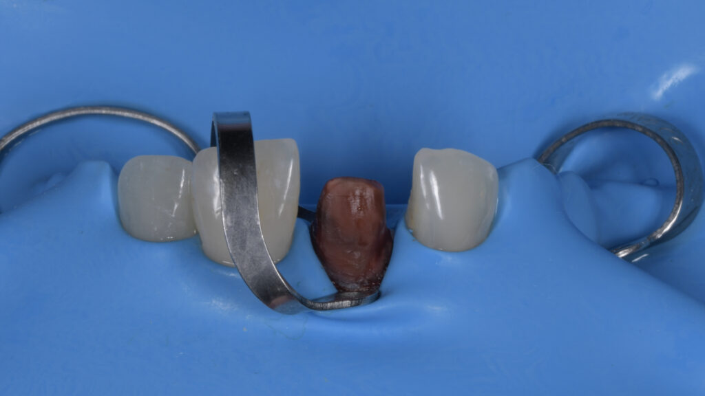 Solving the Single Tooth Dilemma - Oral Health Group