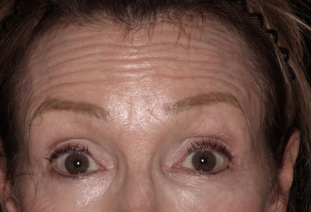 Fig 15. frontalis activated before treatment - Oral Health Group