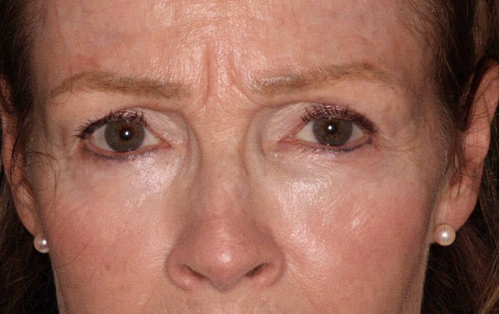 Fig 17. glabella activated before treatment - Oral Health Group