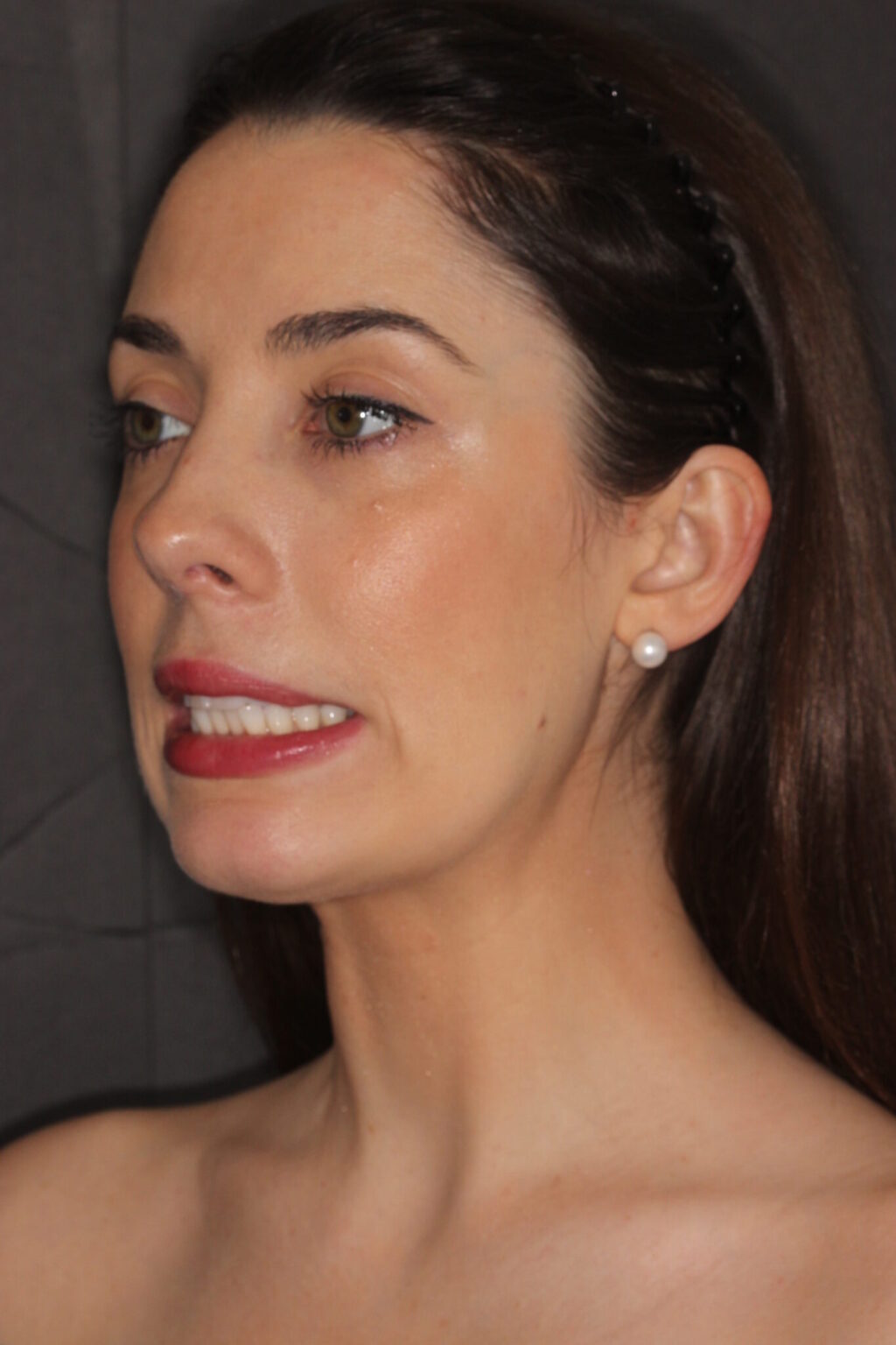 The Synergy Between Cosmetic and Therapeutic Uses of Botulinum Toxin ...