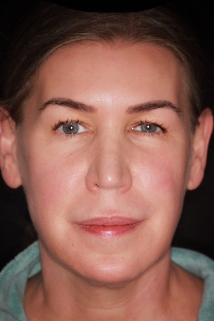 The Synergy Between Cosmetic and Therapeutic Uses of Botulinum Toxin ...