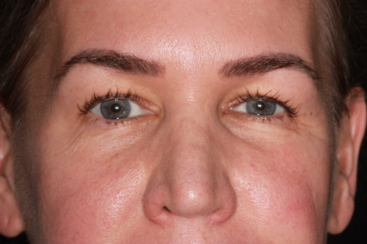 The Synergy Between Cosmetic and Therapeutic Uses of Botulinum Toxin ...
