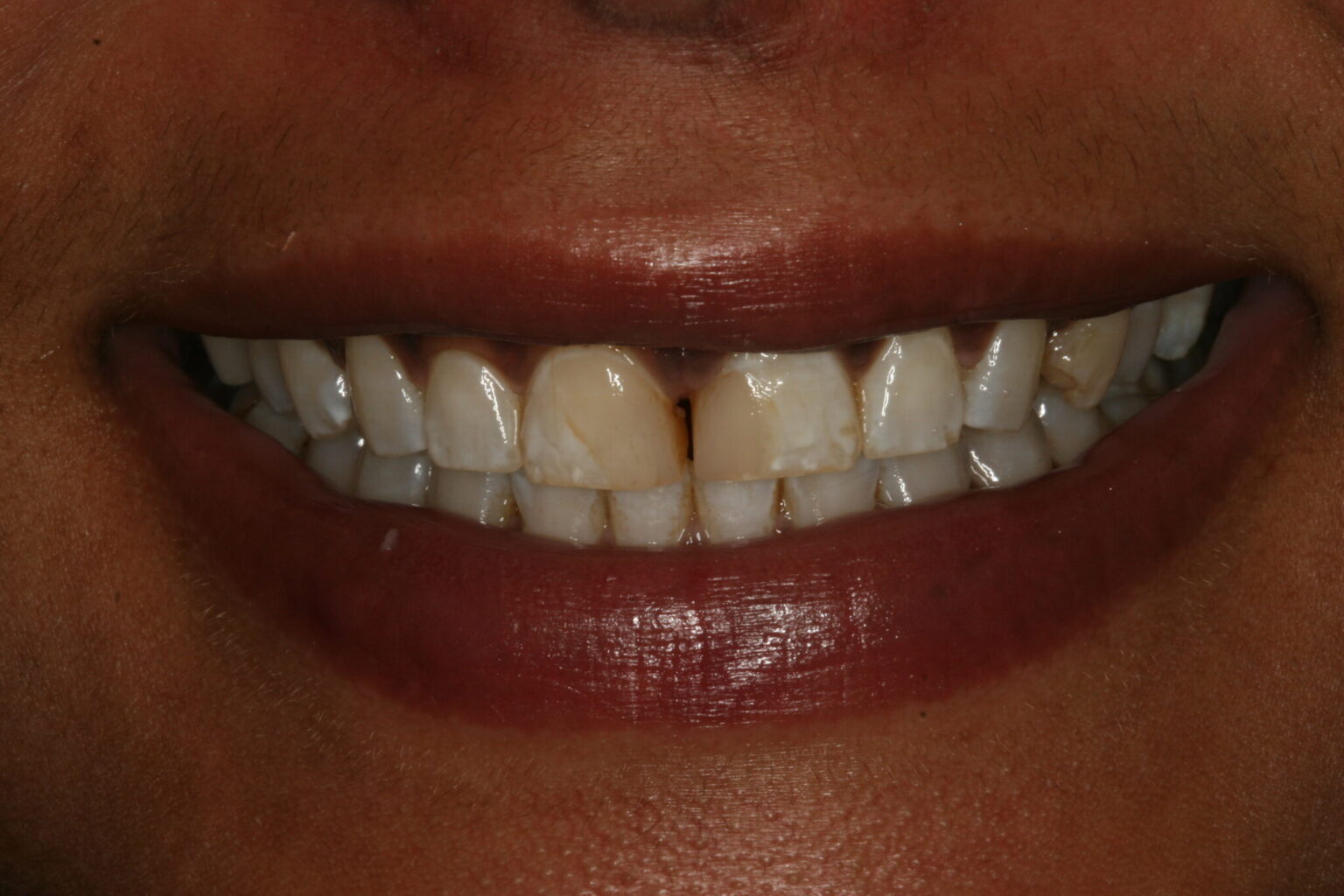 Technology and Emotion: A Porcelain Veneer Case Report