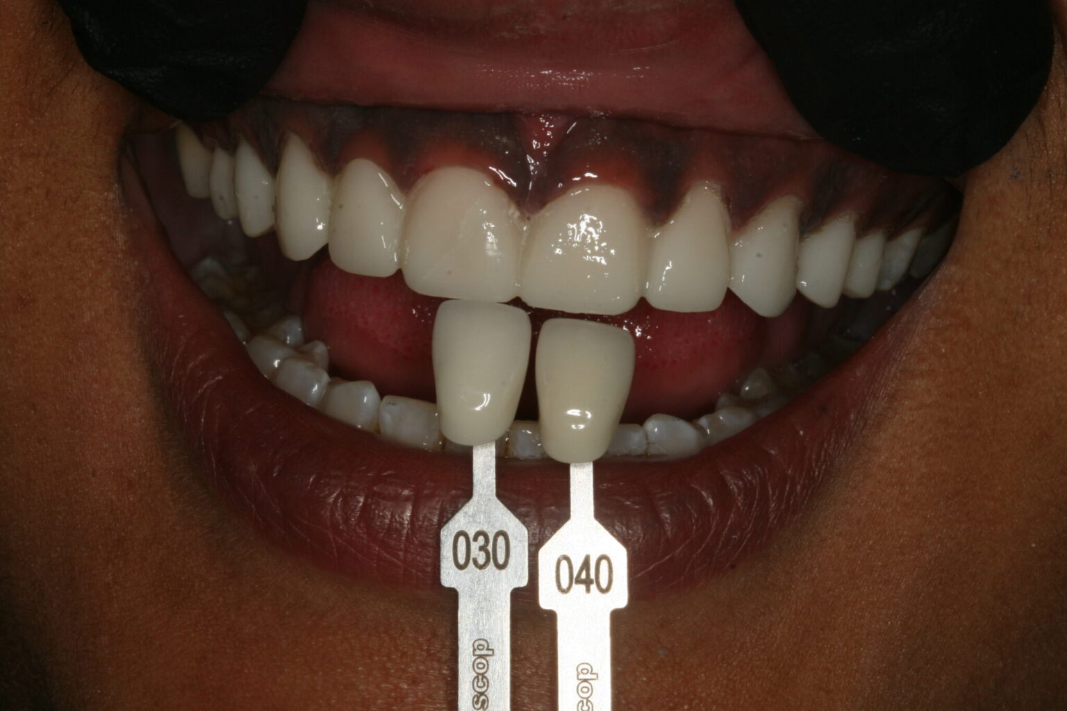 Technology and Emotion: A Porcelain Veneer Case Report