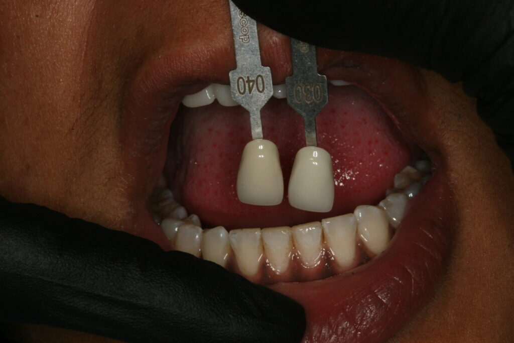 Technology and Emotion: A Porcelain Veneer Case Report