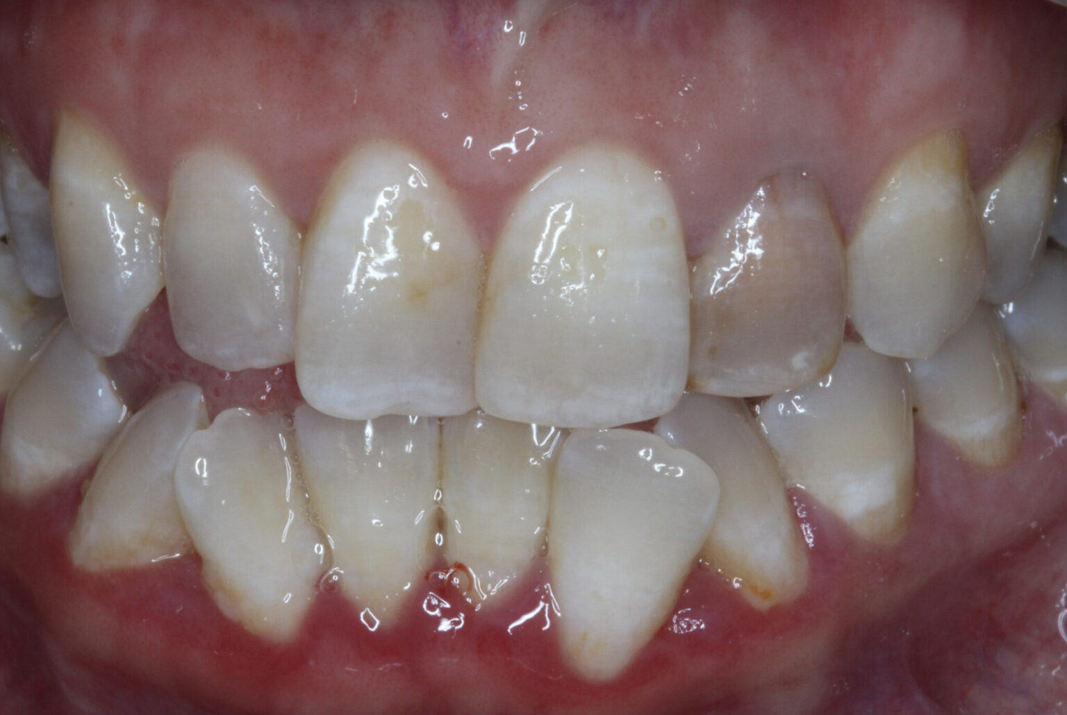 Prevention and Management of Discolored Tooth Preparations