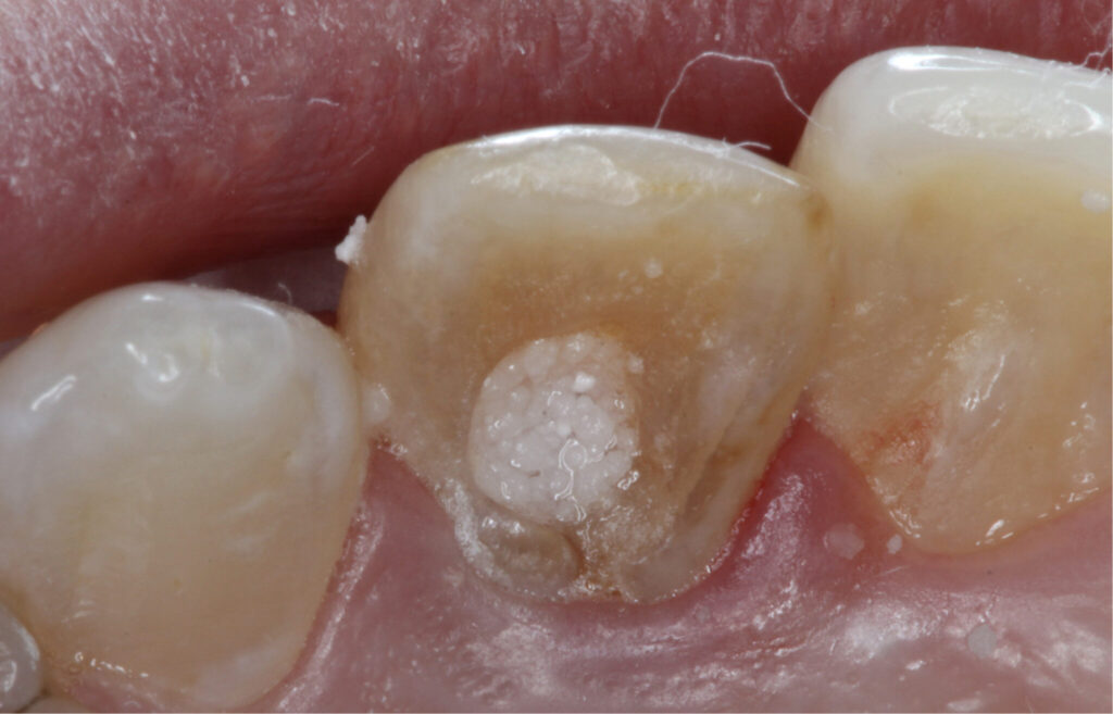 Prevention and Management of Discolored Tooth Preparations