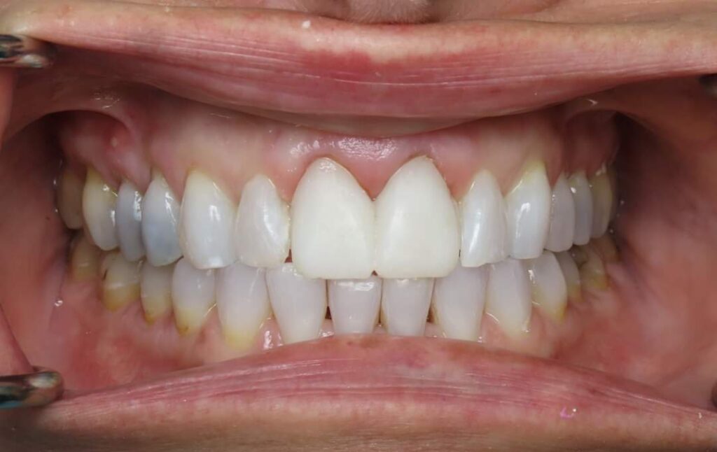 Prevention and Management of Discolored Tooth Preparations
