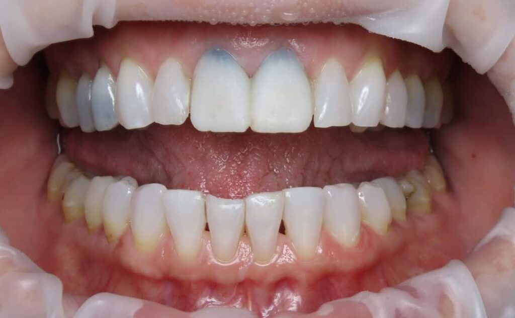 Prevention and Management of Discolored Tooth Preparations