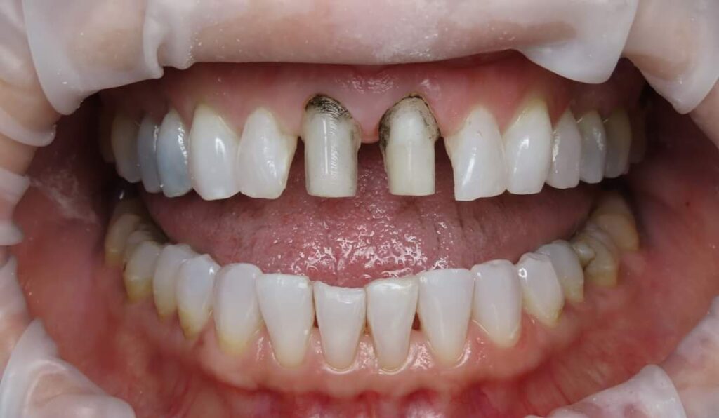 Prevention and Management of Discolored Tooth Preparations