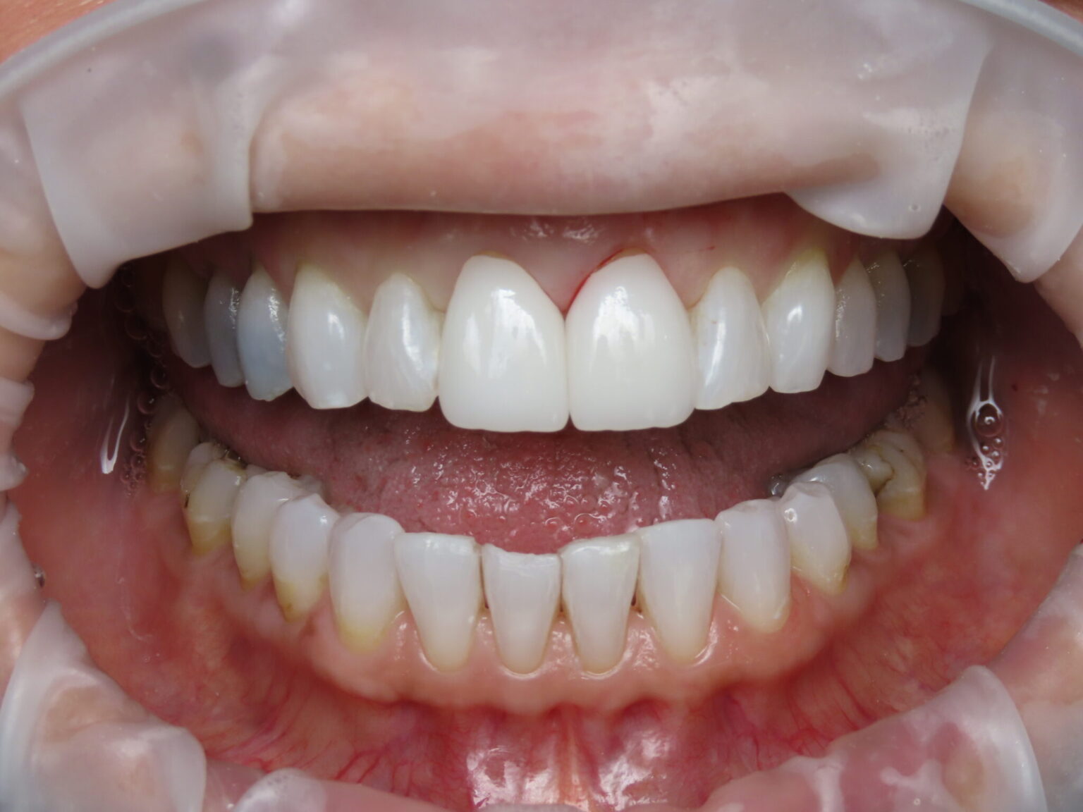 Prevention and Management of Discolored Tooth Preparations