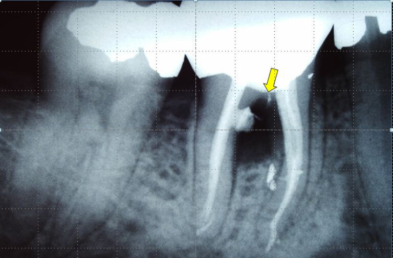 Endodontic Predictability: “What Matters?* - Oral Health Group