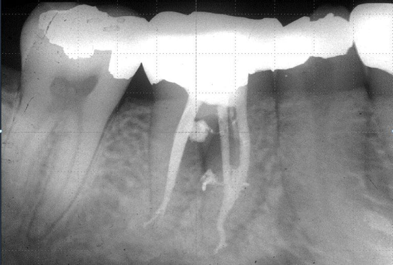 Endodontic Predictability: “What Matters?* - Oral Health Group