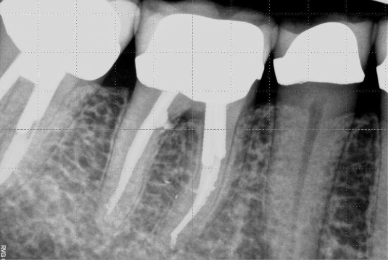 Endodontic Predictability: “What Matters?* - Oral Health Group
