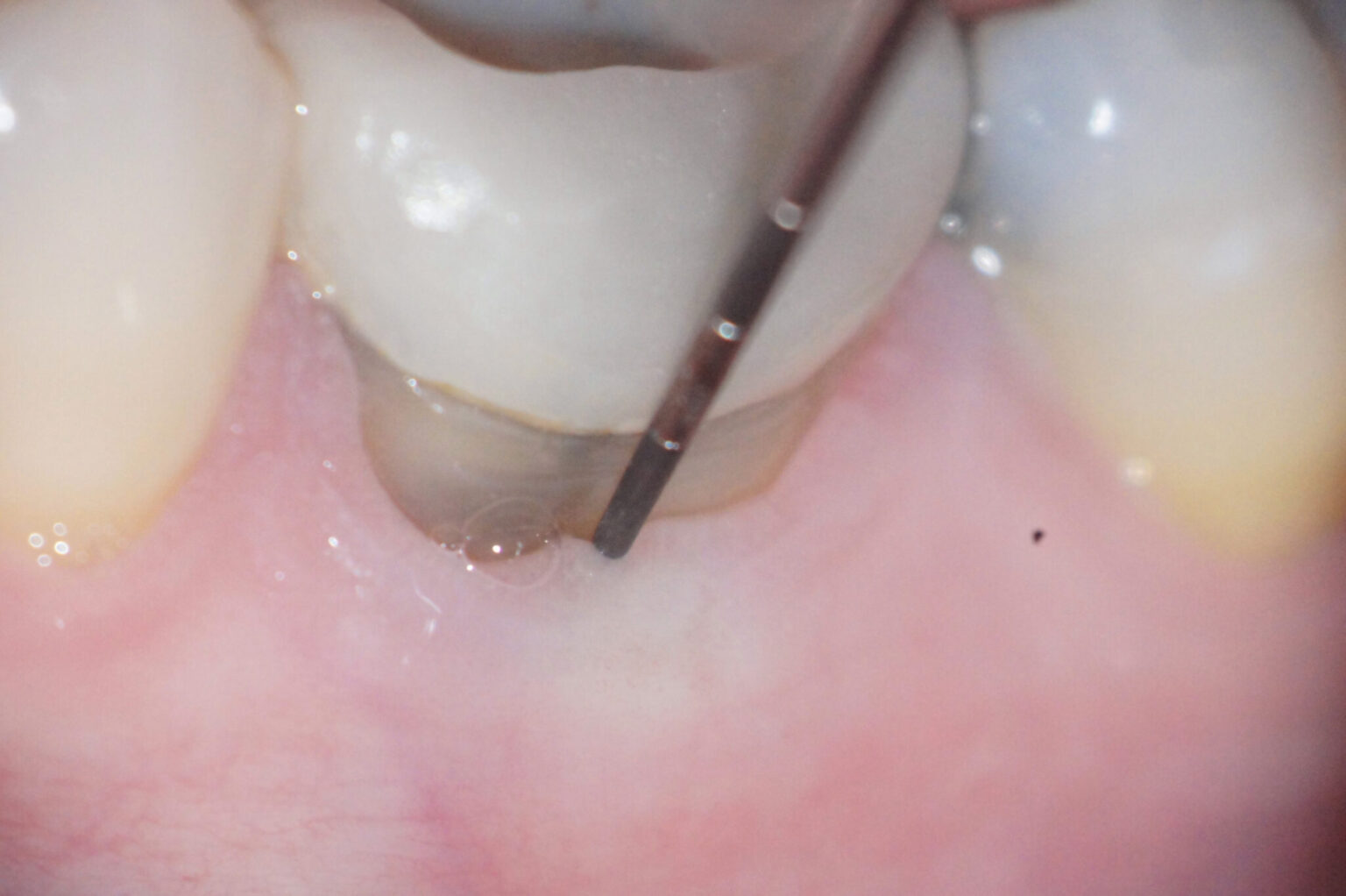 Endodontic Predictability: “What Matters?* - Oral Health Group