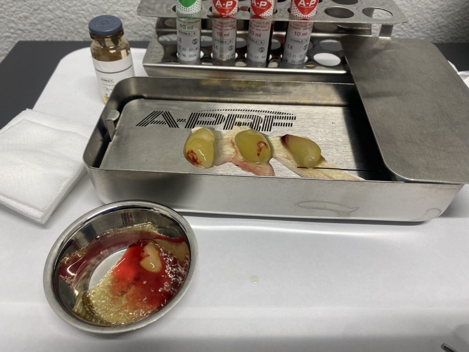 Clinical Application of Platelet-rich Fibrin, Cortical Bone Graft, and ...