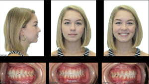 Basics of Corrective Jaw Surgery - Oral Health Group