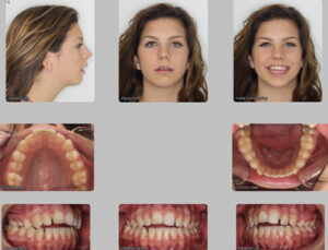 Basics of Corrective Jaw Surgery - Oral Health Group