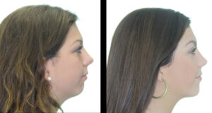 Basics of Corrective Jaw Surgery - Oral Health Group