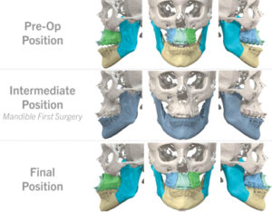 Basics of Corrective Jaw Surgery - Oral Health Group