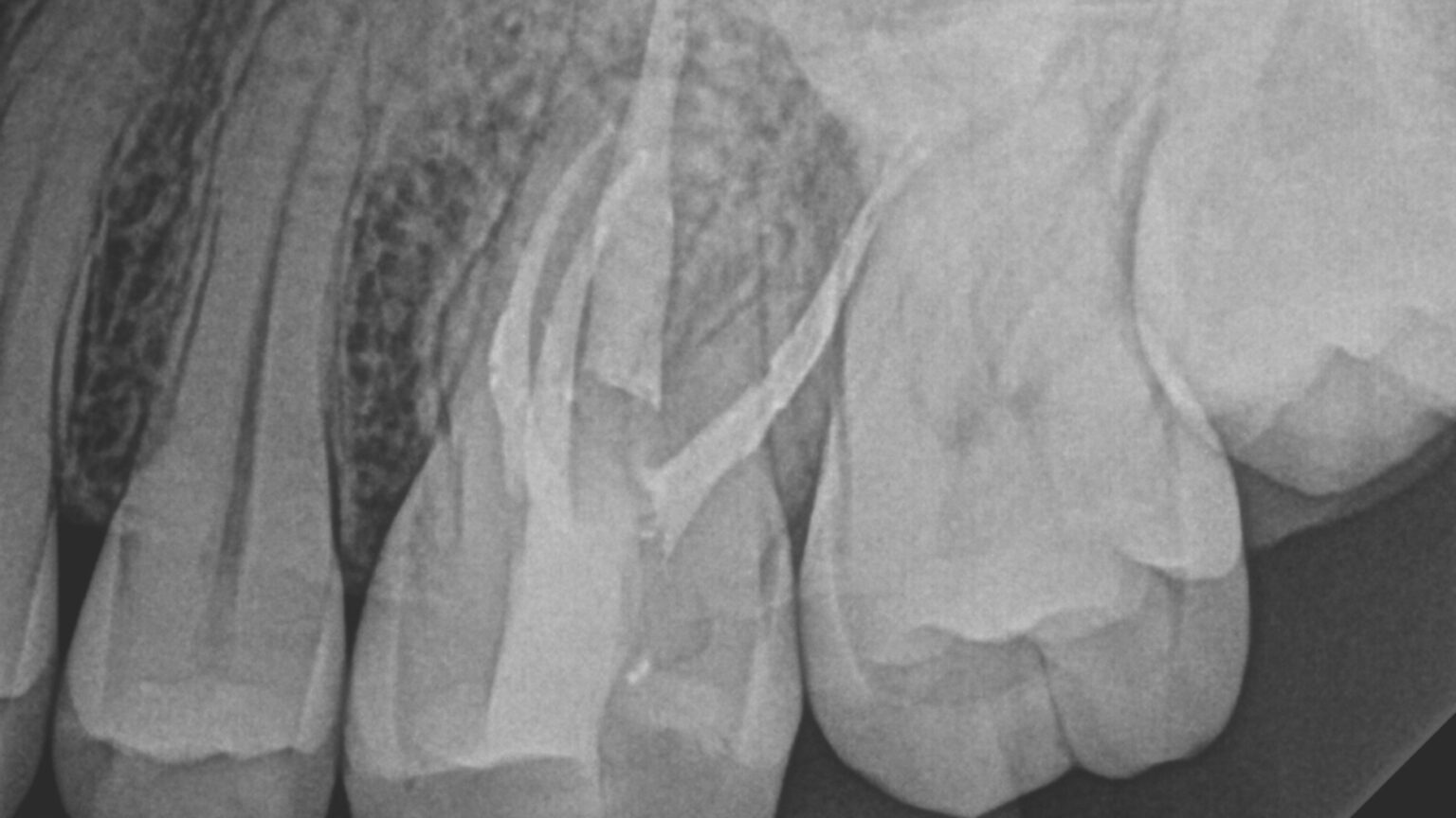 Cutaneous Sinus Tract – A Case Report - Oral Health Group