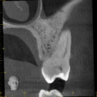 Fig 11 Pre Op coronal view MB root - Oral Health Group