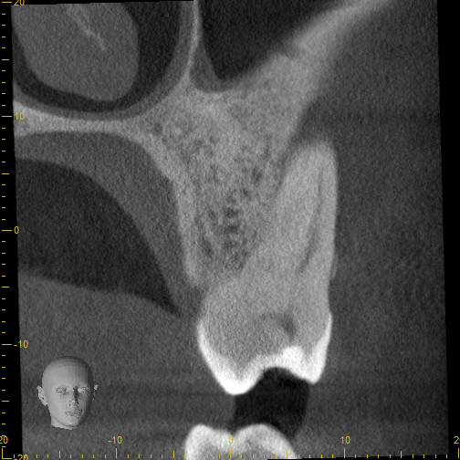 Fig 11 Pre Op coronal view MB root - Oral Health Group