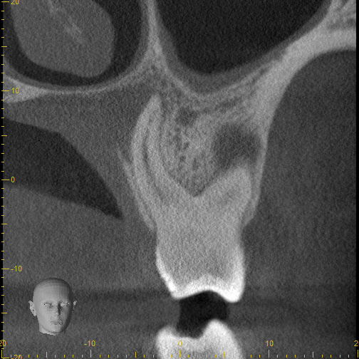 Cutaneous Sinus Tract – A Case Report - Oral Health Group