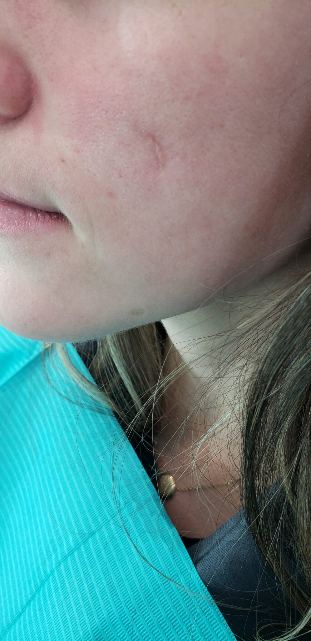 Fig 15 Post op photo 18 months after starting rct - Oral Health Group