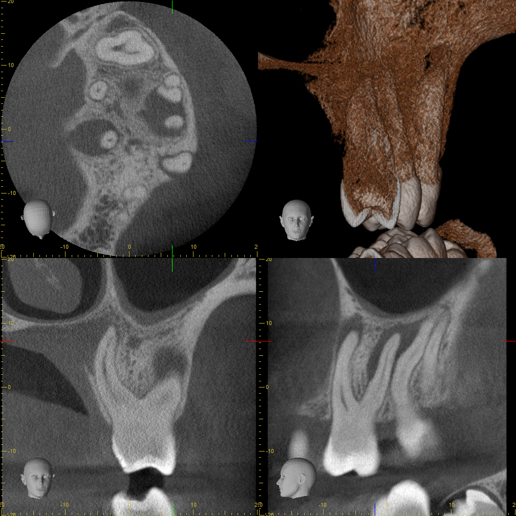 Fig 6 Pre-Op CBCT - Oral Health Group