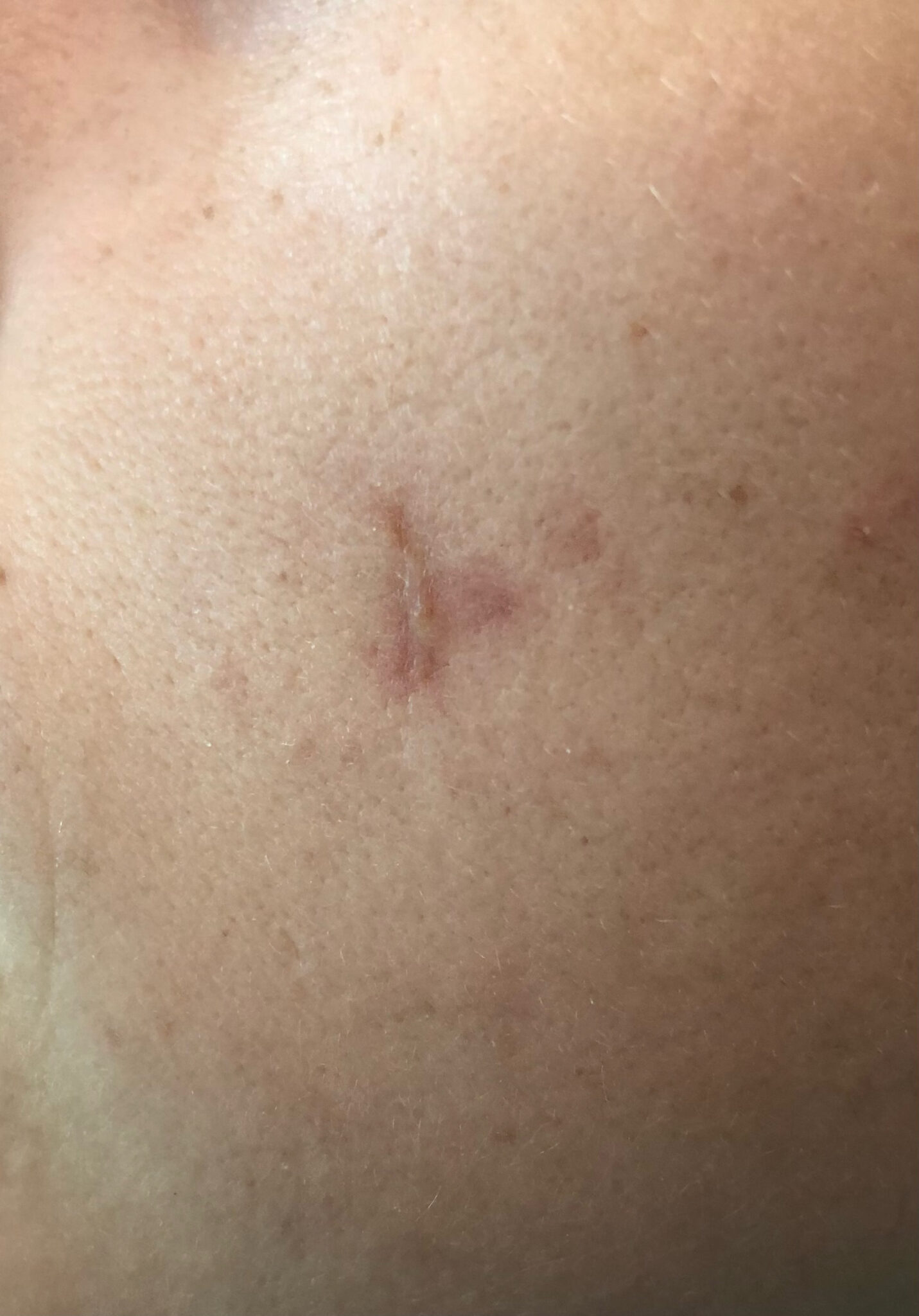 Cutaneous Sinus Tract – A Case Report - Oral Health Group