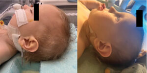 Mandibular Distraction Osteogenesis in the Treatment of Pediatric ...