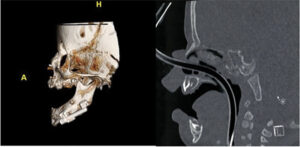 Mandibular Distraction Osteogenesis in the Treatment of Pediatric ...