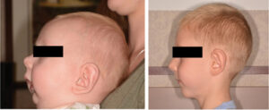 Mandibular Distraction Osteogenesis in the Treatment of Pediatric ...