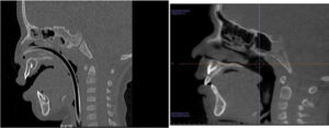 Mandibular Distraction Osteogenesis in the Treatment of Pediatric ...
