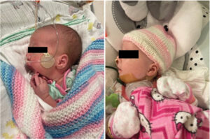 Mandibular Distraction Osteogenesis in the Treatment of Pediatric ...