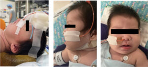 Mandibular Distraction Osteogenesis in the Treatment of Pediatric ...