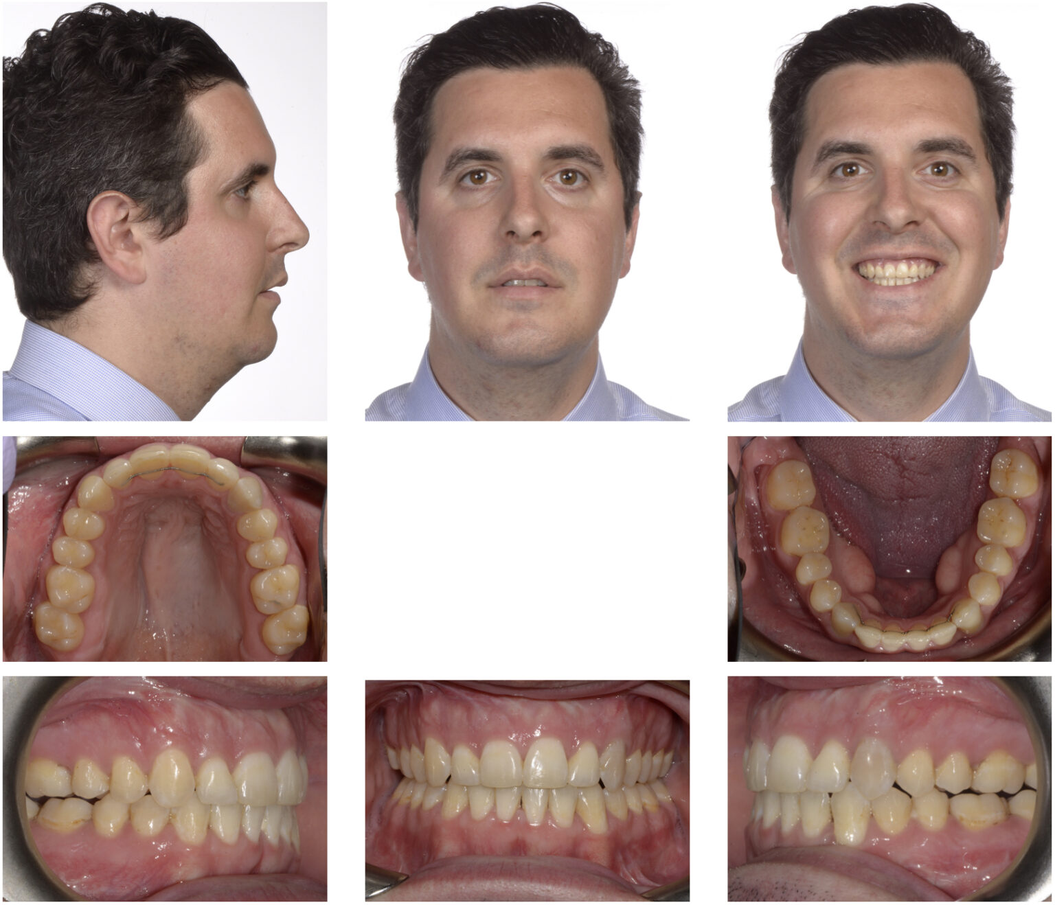 Diagnosis and Management of the Transverse Dimension in Non-Growing ...