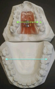 Diagnosis and Management of the Transverse Dimension in Non-Growing ...