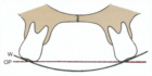 Diagnosis and Management of the Transverse Dimension in Non-Growing ...