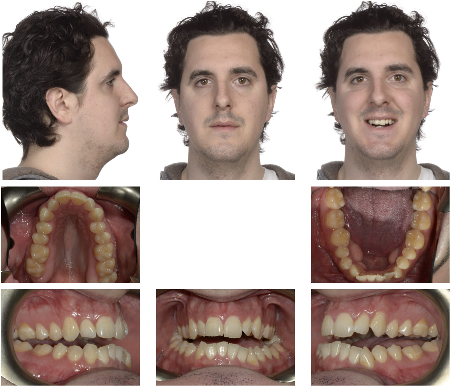 Diagnosis and Management of the Transverse Dimension in Non-Growing ...